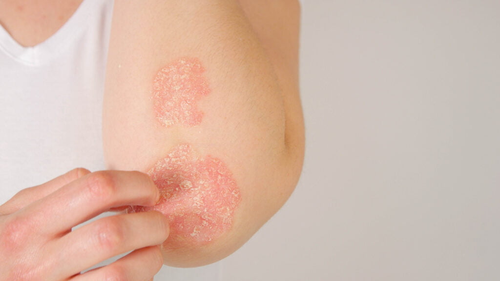 Psoriasis Symptoms Diagnosis And Treatment 24 7medcare