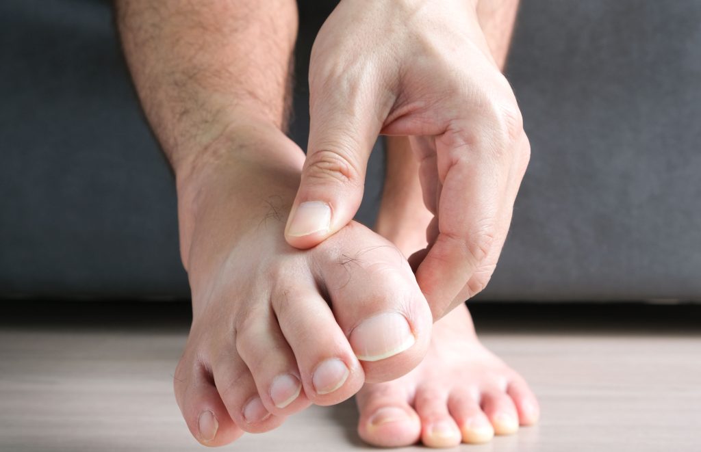 Gout - Symptoms, Diagnosis And Treatment | 24-7Medcare